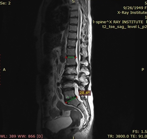 Adult Spinal Deformity - Spine - Orthobullets