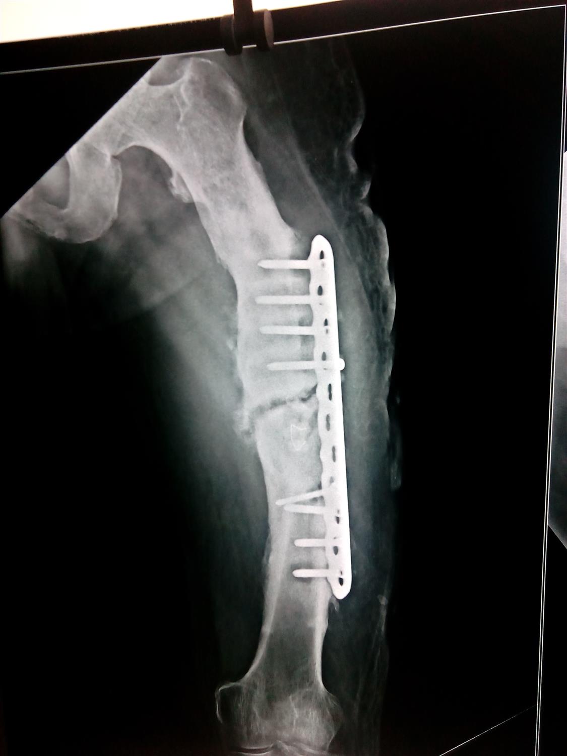 Femoral Shaft Fractures - Trauma - Orthobullets.com
