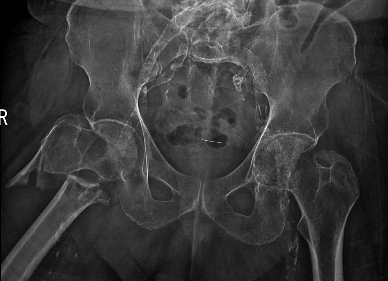 Subtrochanteric Fractures - Trauma - Orthobullets