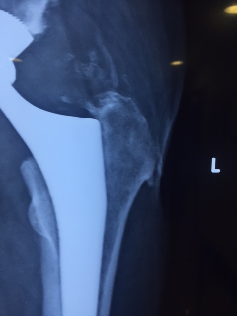 Prosthetic Joint Infection - Recon - Orthobullets