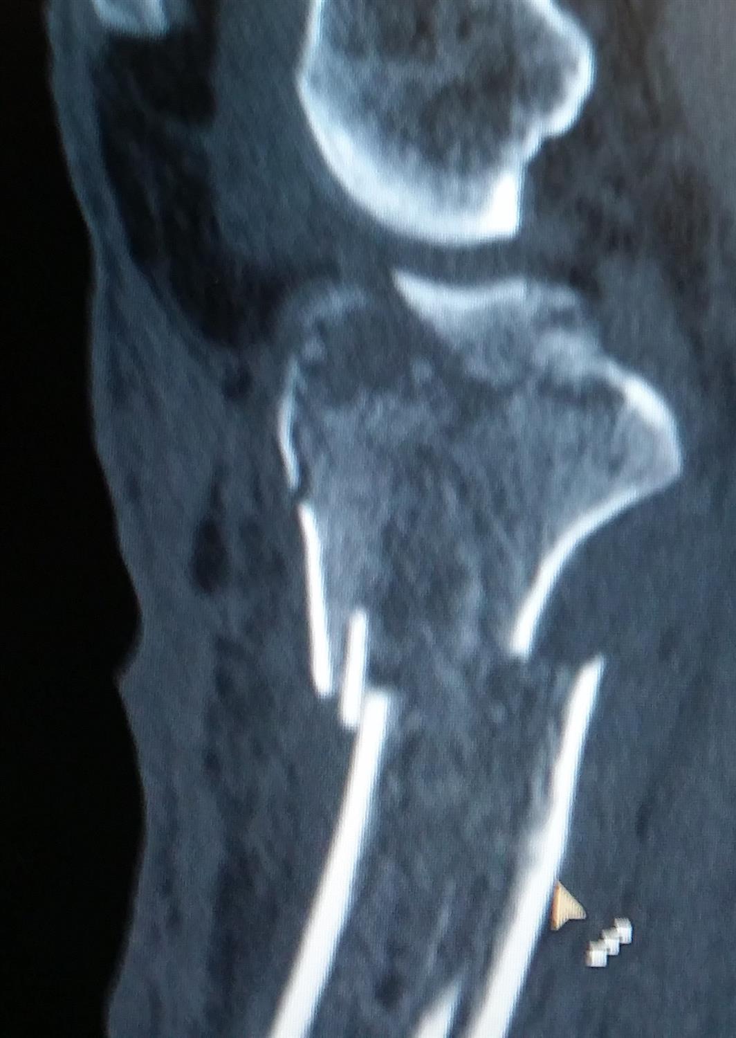 Tibial Plateau Fractures - Trauma - Orthobullets