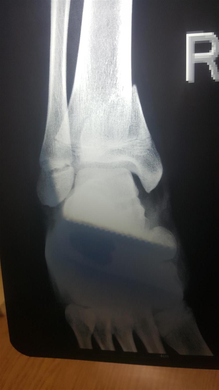 Ankle Fractures - Pediatric - Pediatrics - Orthobullets