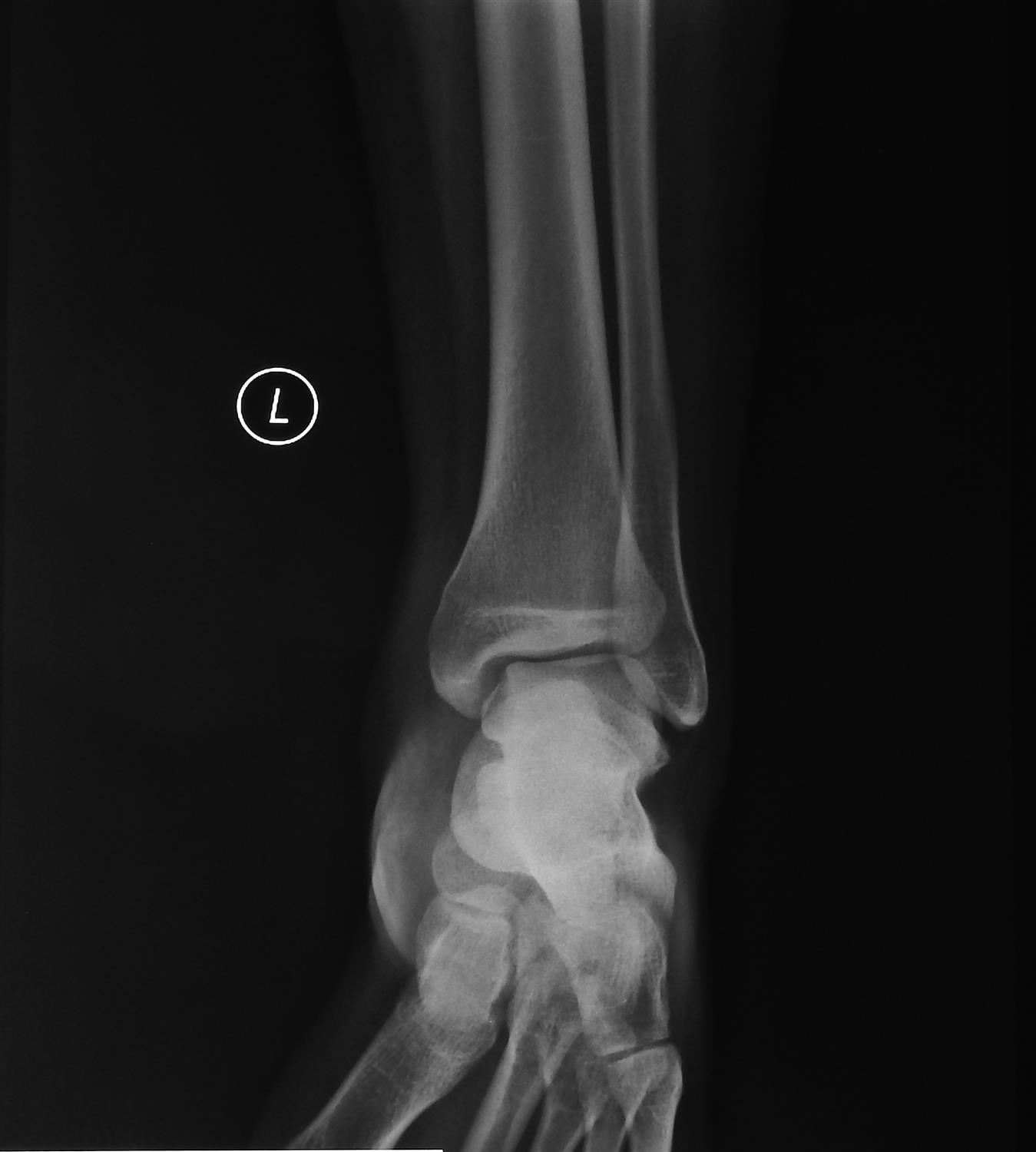 Ankle Fractures - Trauma - Orthobullets.com