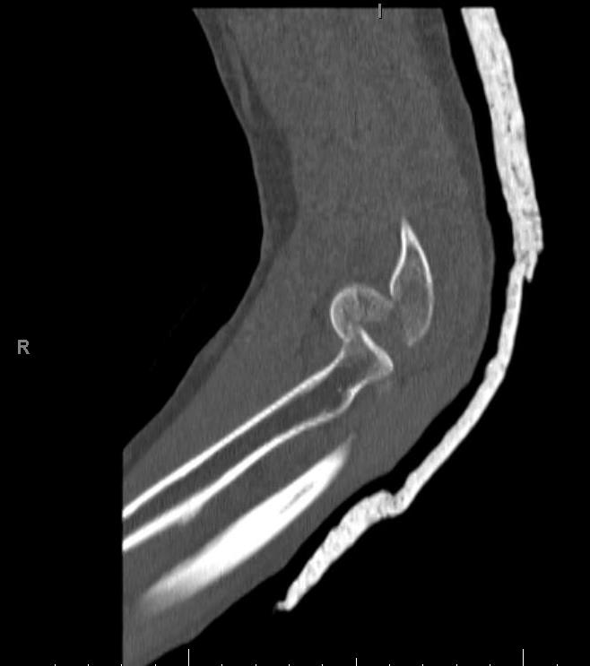 Capitellum Fractures - Trauma - Orthobullets