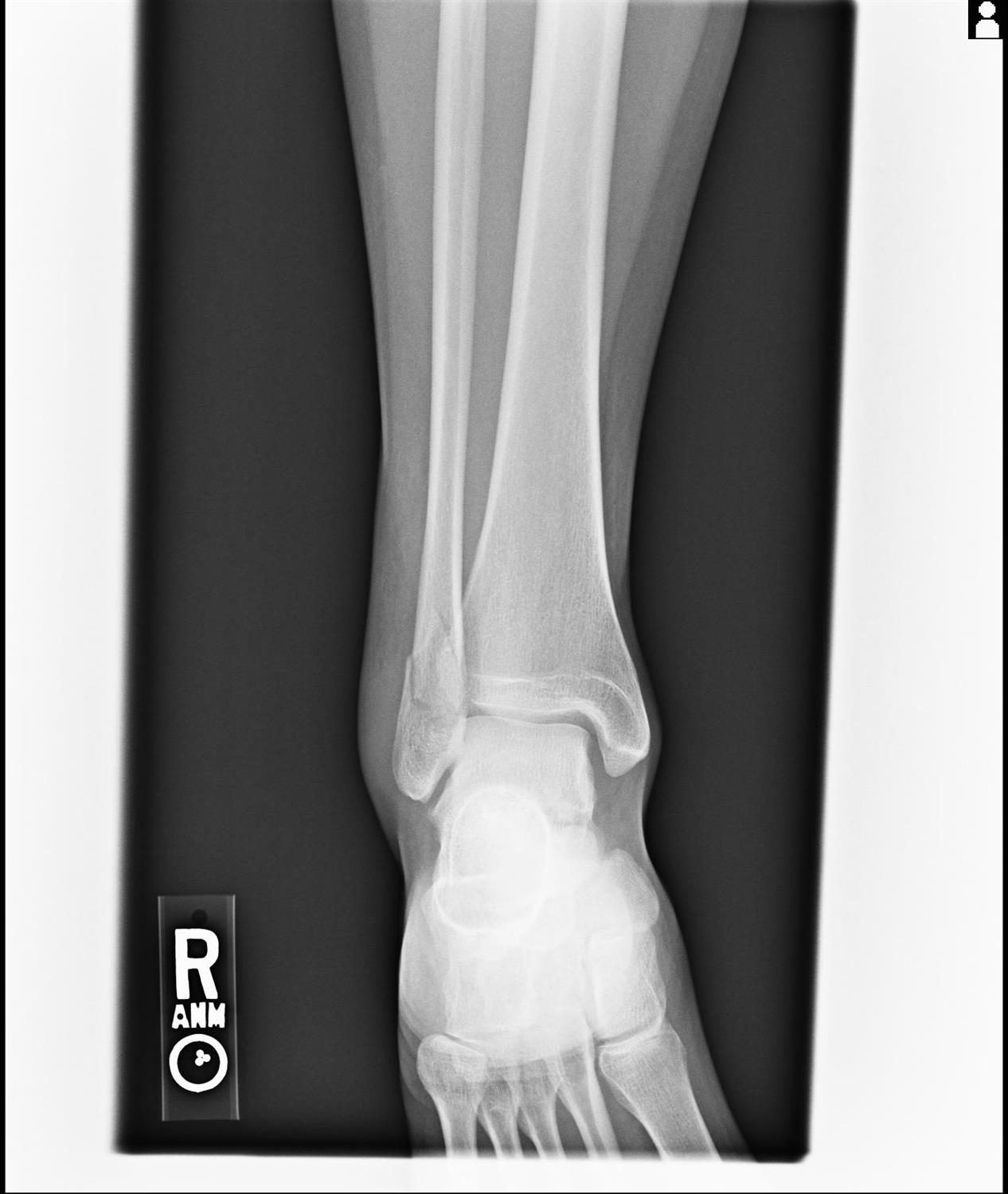 Ankle Fractures - Trauma - Orthobullets.com