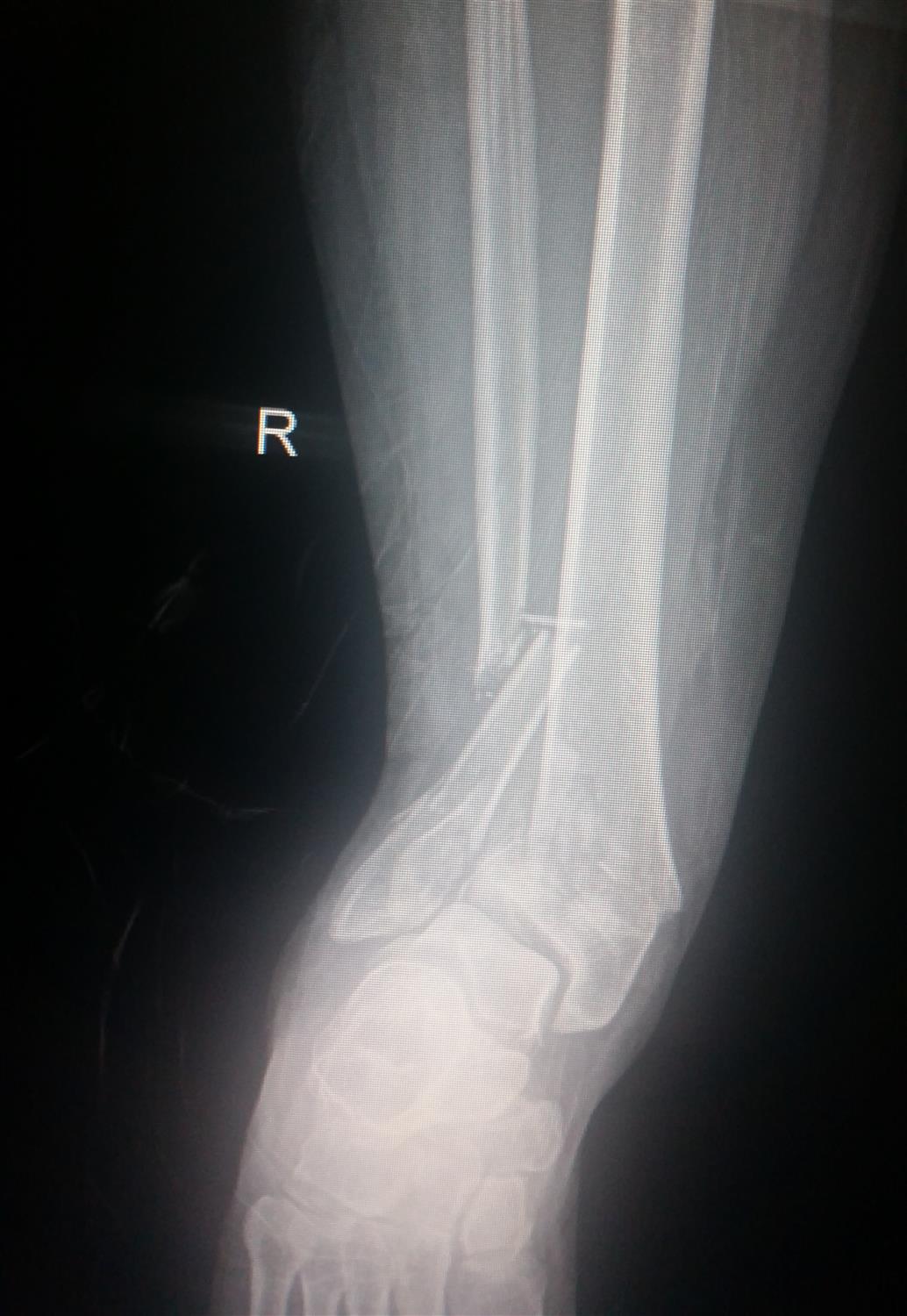 Ankle Fractures - Trauma - Orthobullets.com