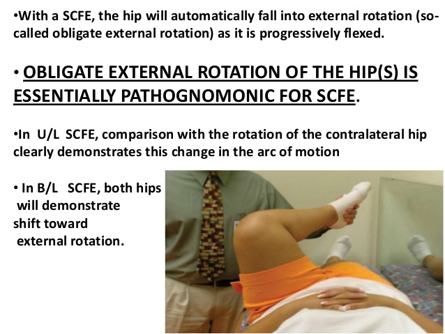 Slipped Capital Femoral Epiphysis (SCFE) - Pediatrics - Orthobullets