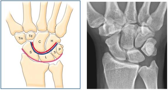 Lunotriquetral Ligament Injury & VISI - Hand - Orthobullets