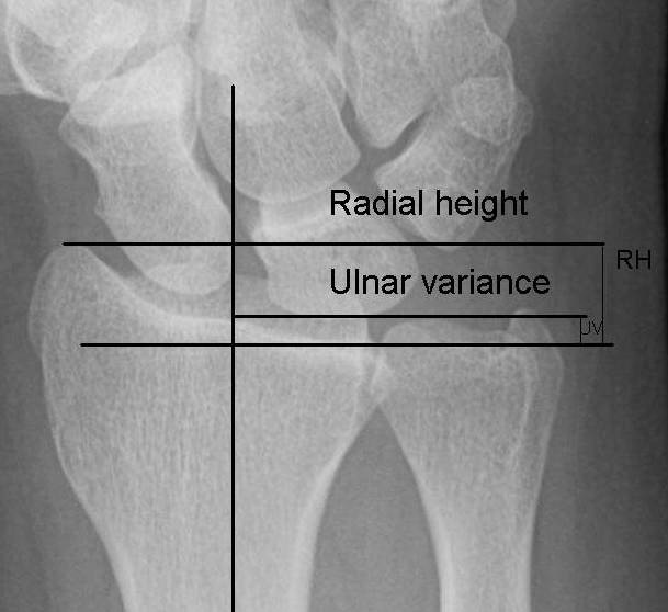Ulnar Variance - Hand - Orthobullets