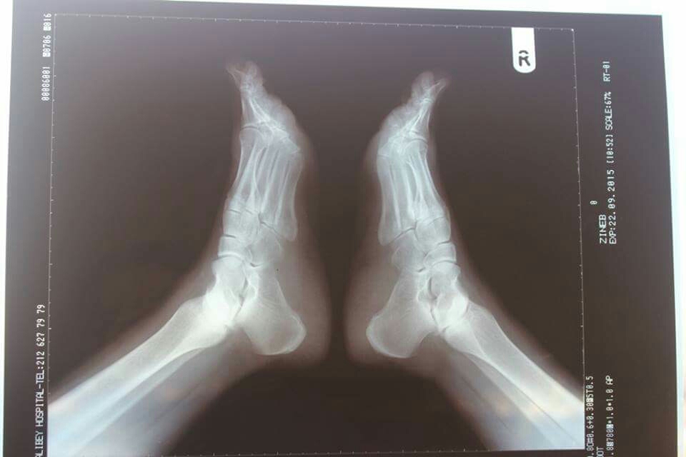 Acquired Spastic Equinovarus Deformity - Foot & Ankle - Orthobullets