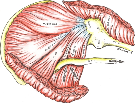 Retro-trochanteric sciatica-like pain: current concept. - Post ...
