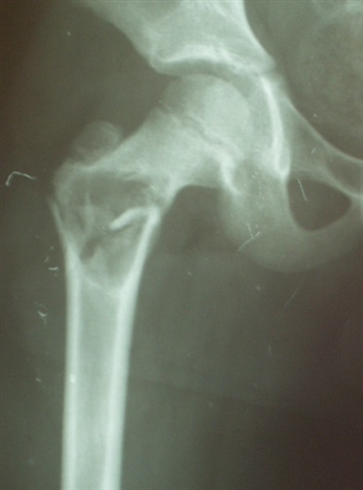 Unicameral Bone Cyst - Pathology - Orthobullets