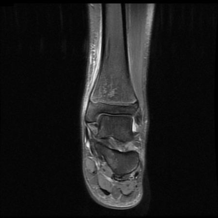 Osteomyelitis - Pediatric - Pediatrics - Orthobullets