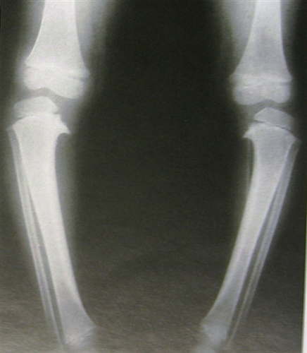 Infantile Blount's Disease (tibia vara) - Pediatrics - Orthobullets