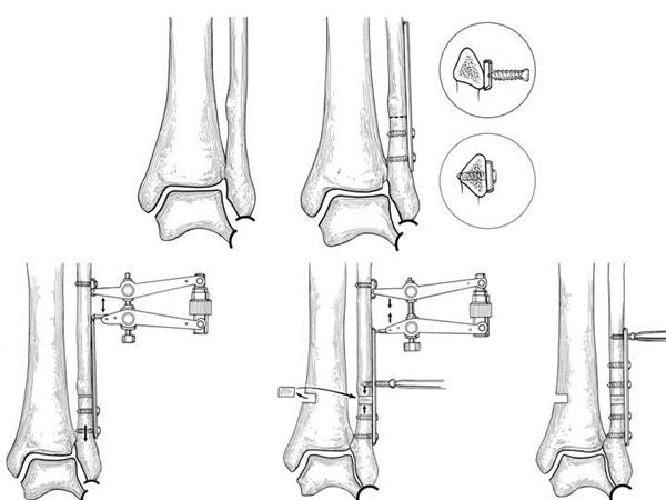 Question 1091 - Qbank - Orthobullets