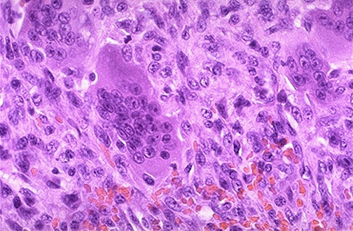Giant Cell Tumor - Pathology - Orthobullets