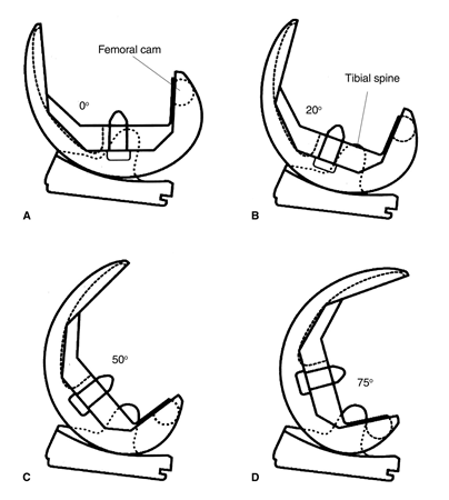 TKA Prosthesis Design - Recon - Orthobullets