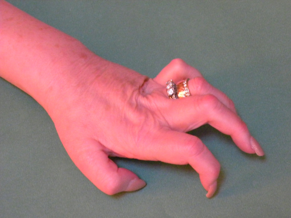 Question 1203 - Qbank - Orthobullets