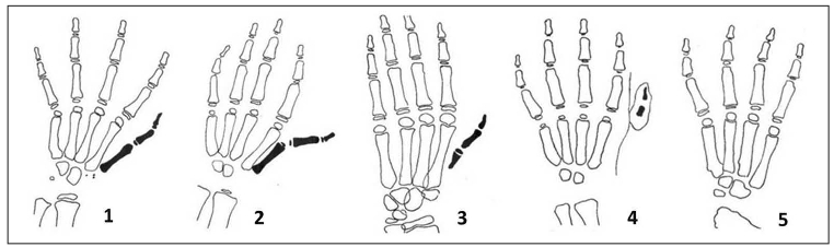 Thumb Hypoplasia - Hand - Orthobullets