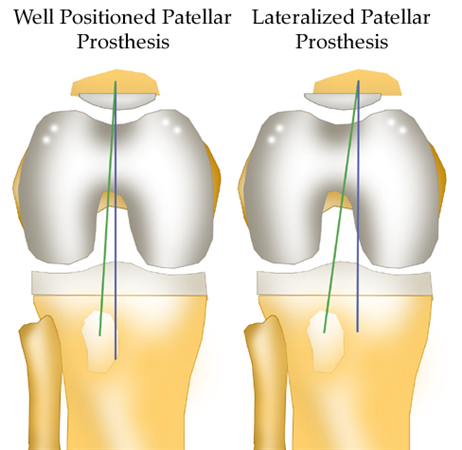 TKA Patellofemoral Alignment - Recon - Orthobullets