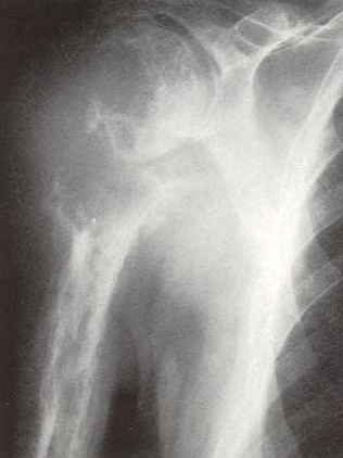 Paget's Disease - Pathology - Orthobullets