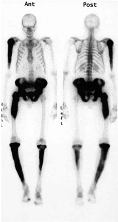Paget's Disease - Pathology - Orthobullets