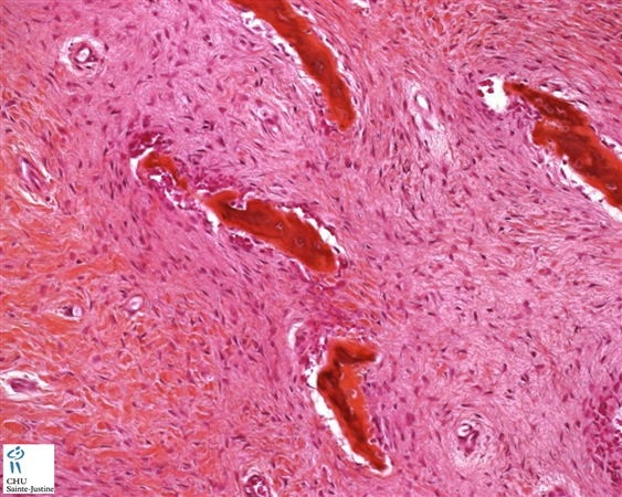 Synovial Sarcoma - Pathology - Orthobullets