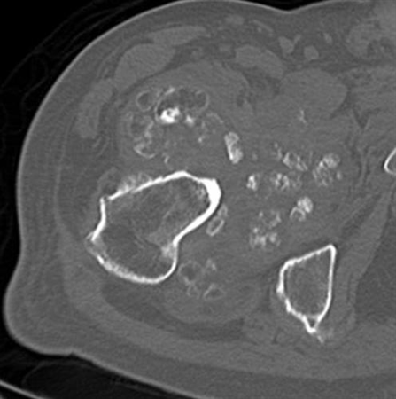 Synovial Chondromatosis - Pathology - Orthobullets