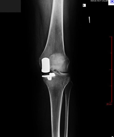 Unicompartmental Knee Replacement - Recon - Orthobullets