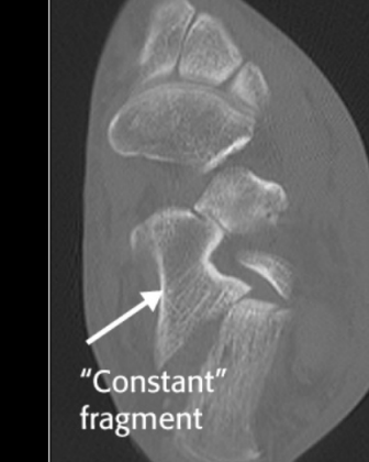 Calcaneus Fractures - Trauma - Orthobullets
