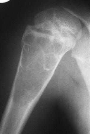 Question 1384 - Qbank - Orthobullets