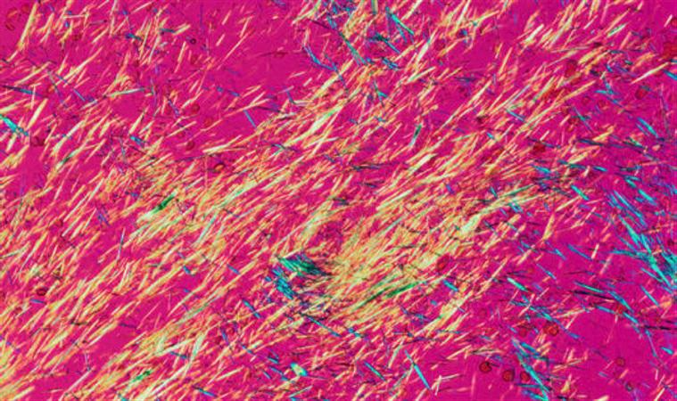 Pseudogout (CPPD) - Basic Science - Orthobullets