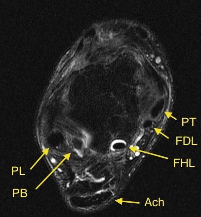 FHL Tendonitis & Injuries - Foot & Ankle - Orthobullets
