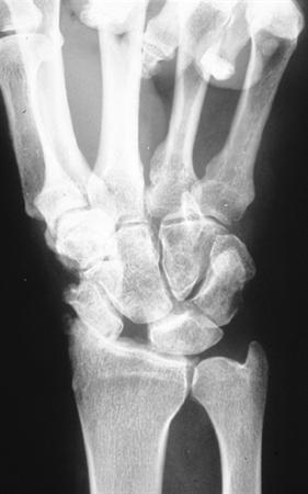 Scapholunate Ligament Injury & DISI - Hand - Orthobullets