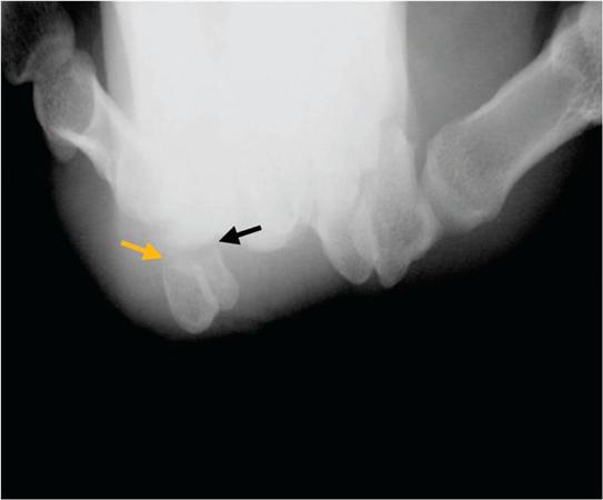 Hook of Hamate Fracture - Hand - Orthobullets