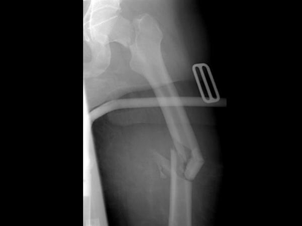 Question 150 - Qbank - Orthobullets