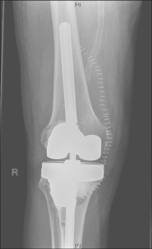 TKA Revision - Recon - Orthobullets