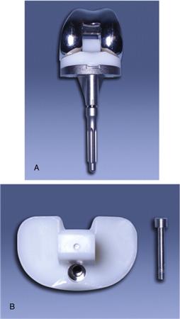TKA Prosthesis Design - Recon - Orthobullets
