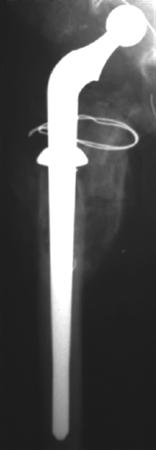 Question 1647 - Qbank - Orthobullets