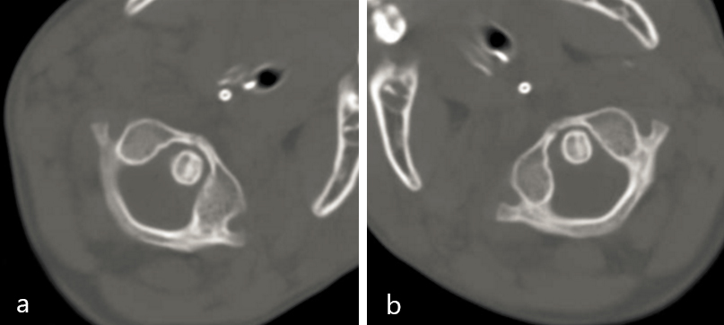 Atlantoaxial Rotatory Displacement (AARD) - Spine - Orthobullets
