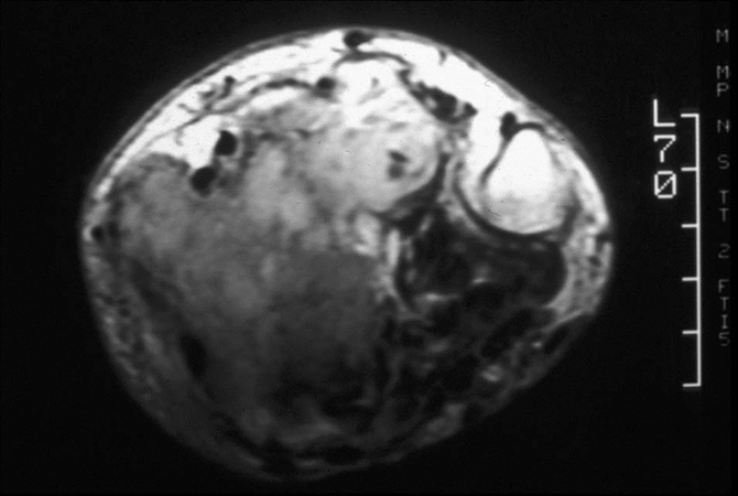 Giant Cell Tumor - Pathology - Orthobullets