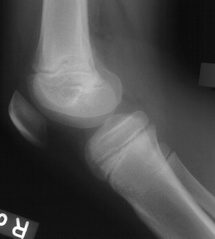 Osteomyelitis - Pediatric - Pediatrics - Orthobullets
