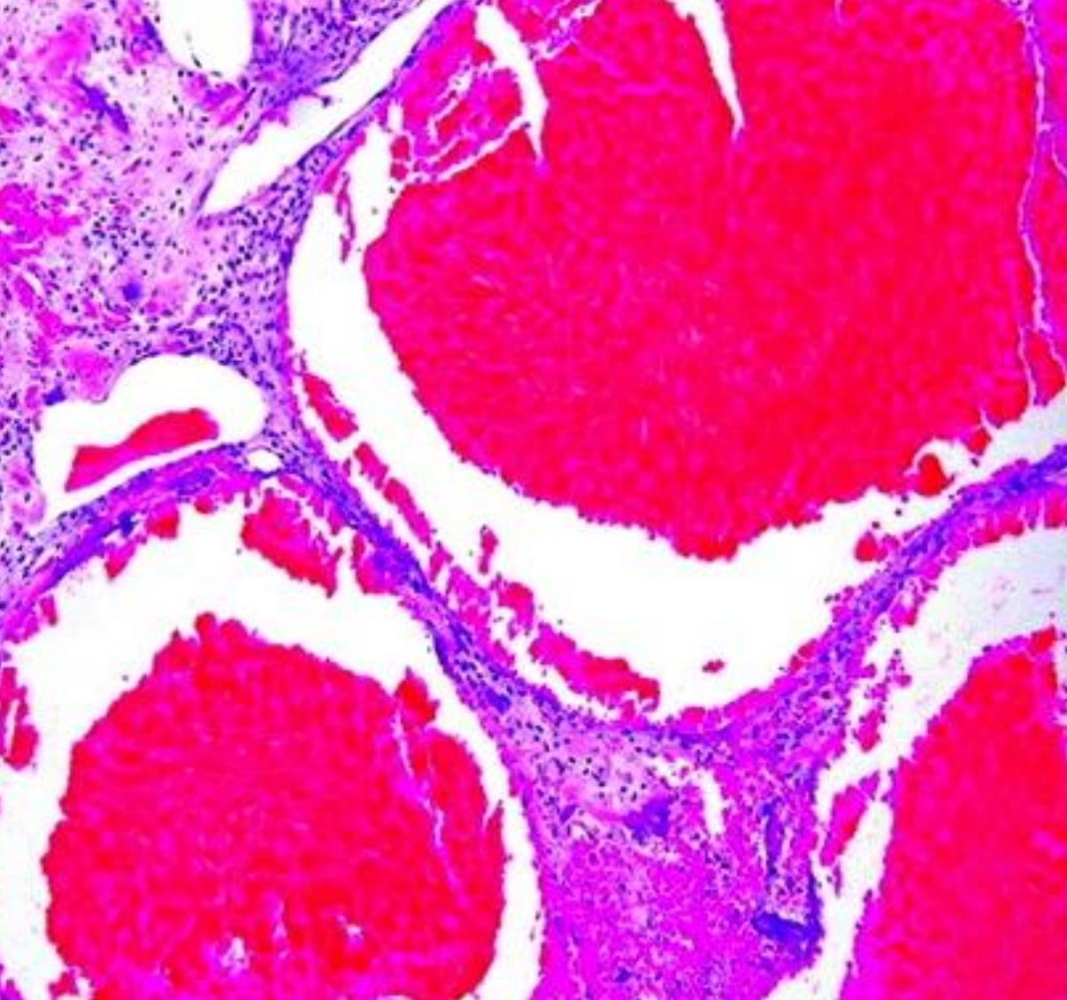 Unicameral Bone Cyst - Pathology - Orthobullets
