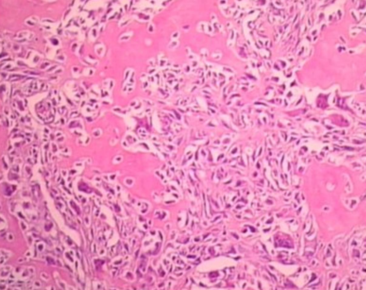 Unicameral Bone Cyst - Pathology - Orthobullets