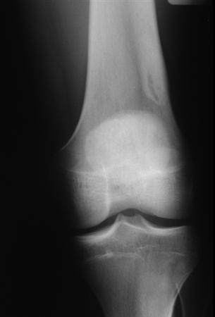 Non-Ossifying Fibroma - Pathology - Orthobullets