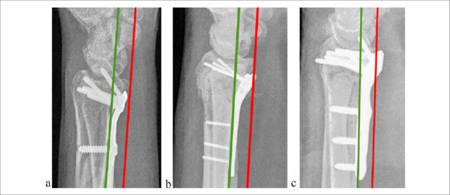 Question 210174 - Qbank - Orthobullets