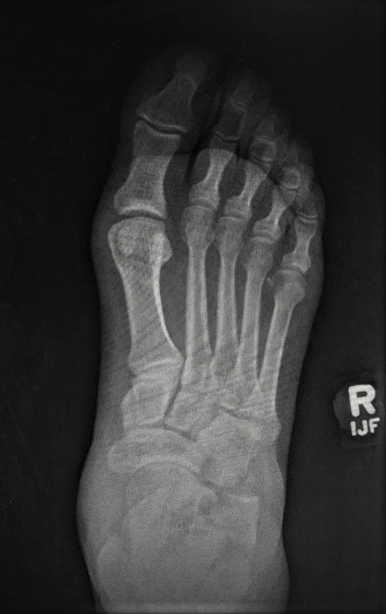 Calcaneus Fractures - Trauma - Orthobullets