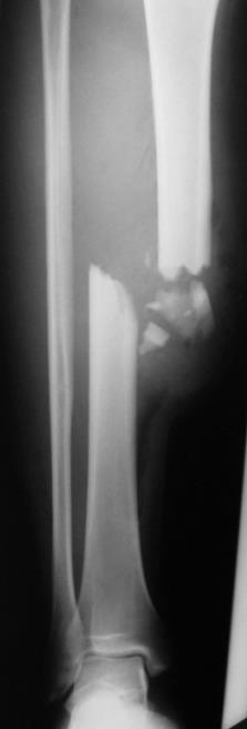 Osteomyelitis - Adult - Trauma - Orthobullets