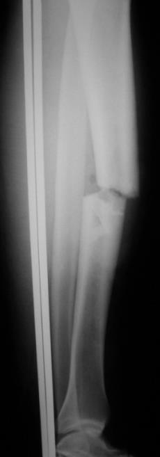 Osteomyelitis - Adult - Trauma - Orthobullets
