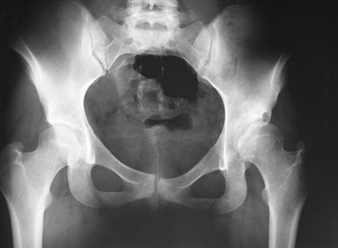 A systematic approach to the plain radiographic evaluation of the young ...